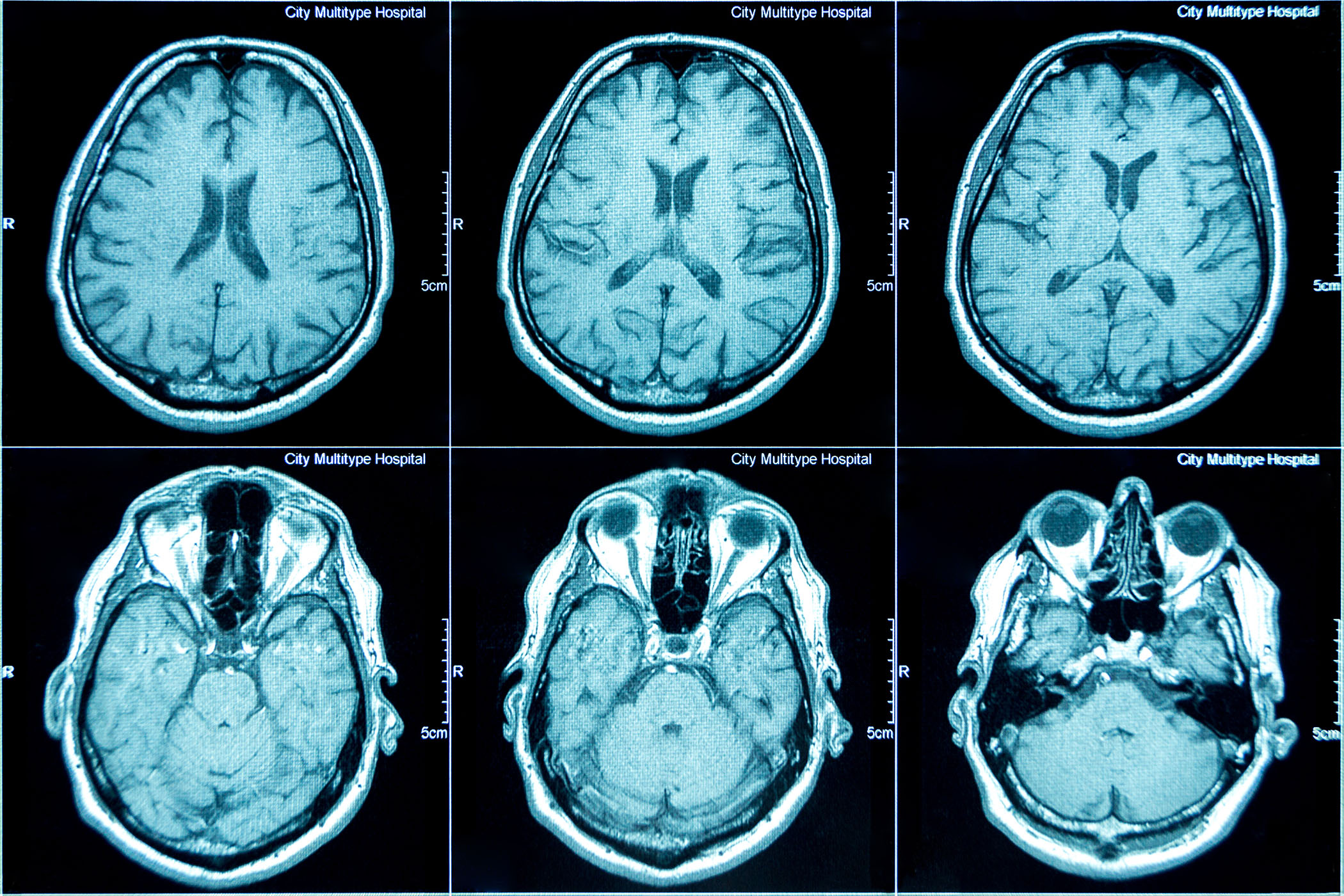 Blue Brain Scan Brain Scan Distinguishes Between Bipolar Disorder,