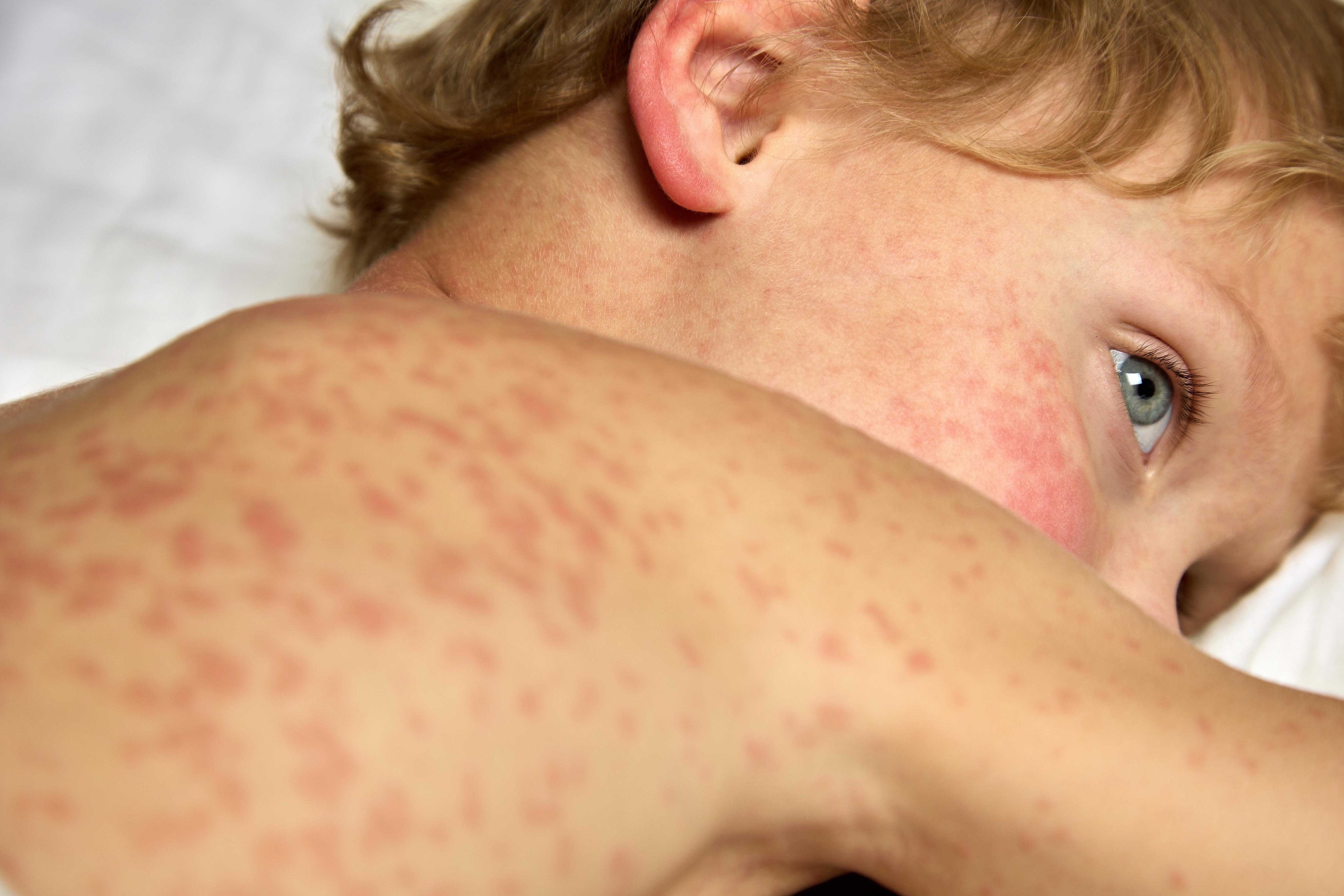 America’s Measles Outbreak: What You Need to Know | Rutgers University