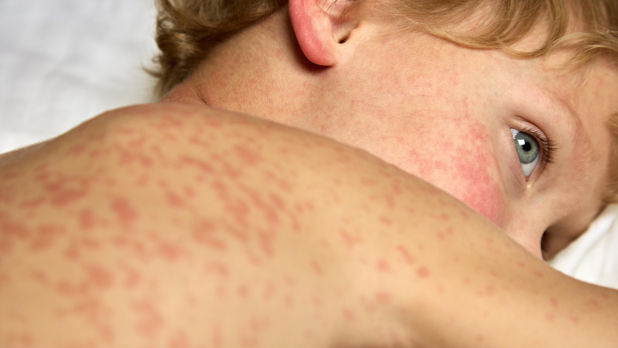 America’s Measles Outbreak: What You Need to Know | Rutgers University